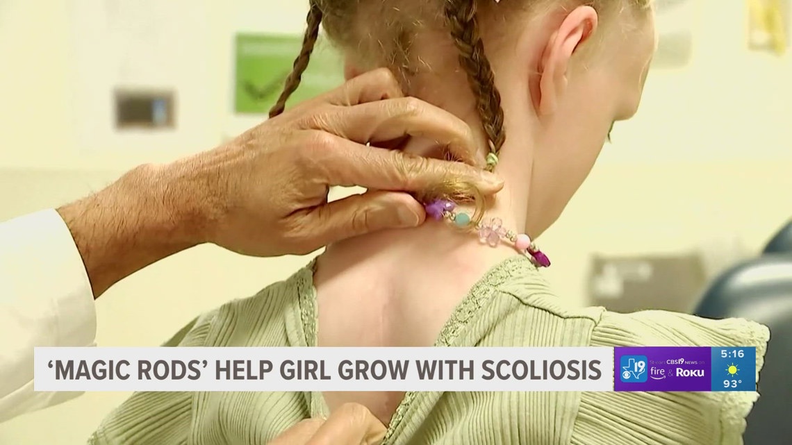 'Magic rods' help girl with scoliosis grow | cbs19.tv