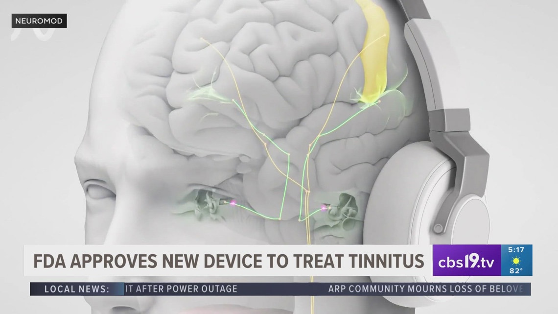 FDA approves new device to treat tinnitus | cbs19.tv