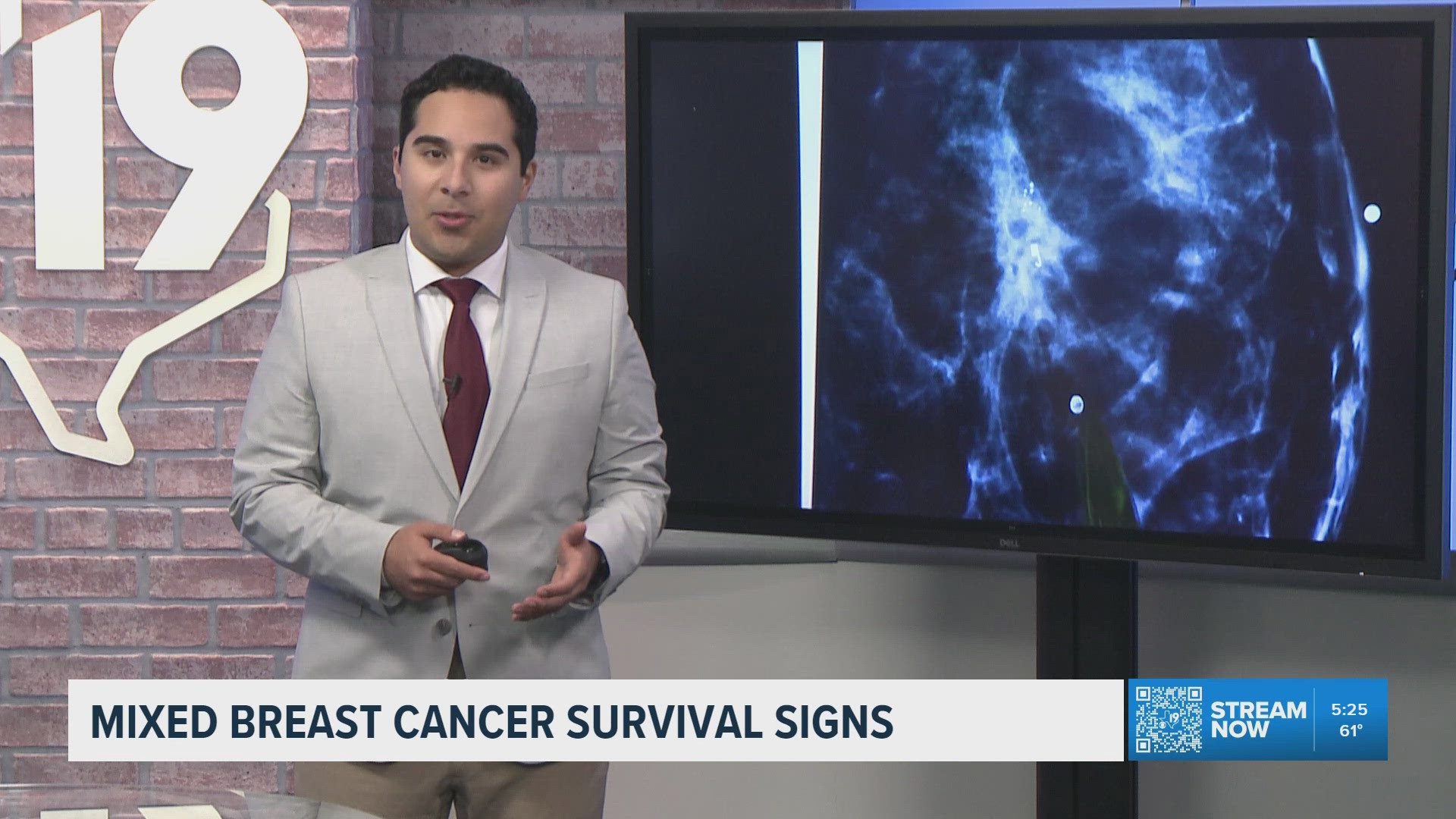 Study finds rise in stage 4 breast cancer diagnoses despite survival ...