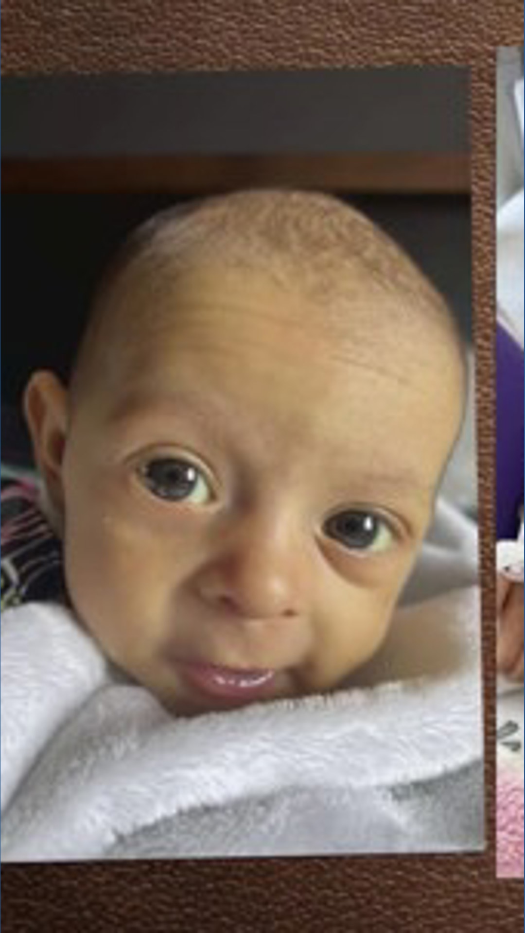 Rare surgery uses one liver to save two lives | cbs19.tv