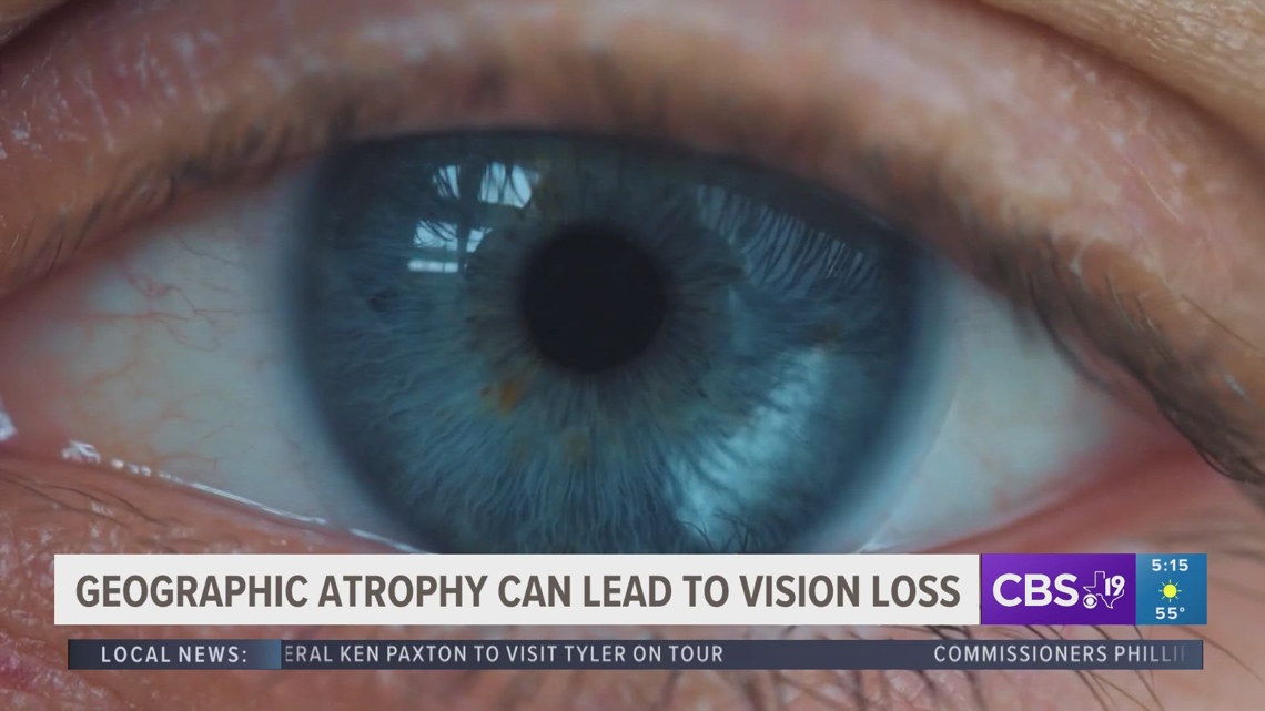 Geographic atrophy can lead to vision loss | cbs19.tv