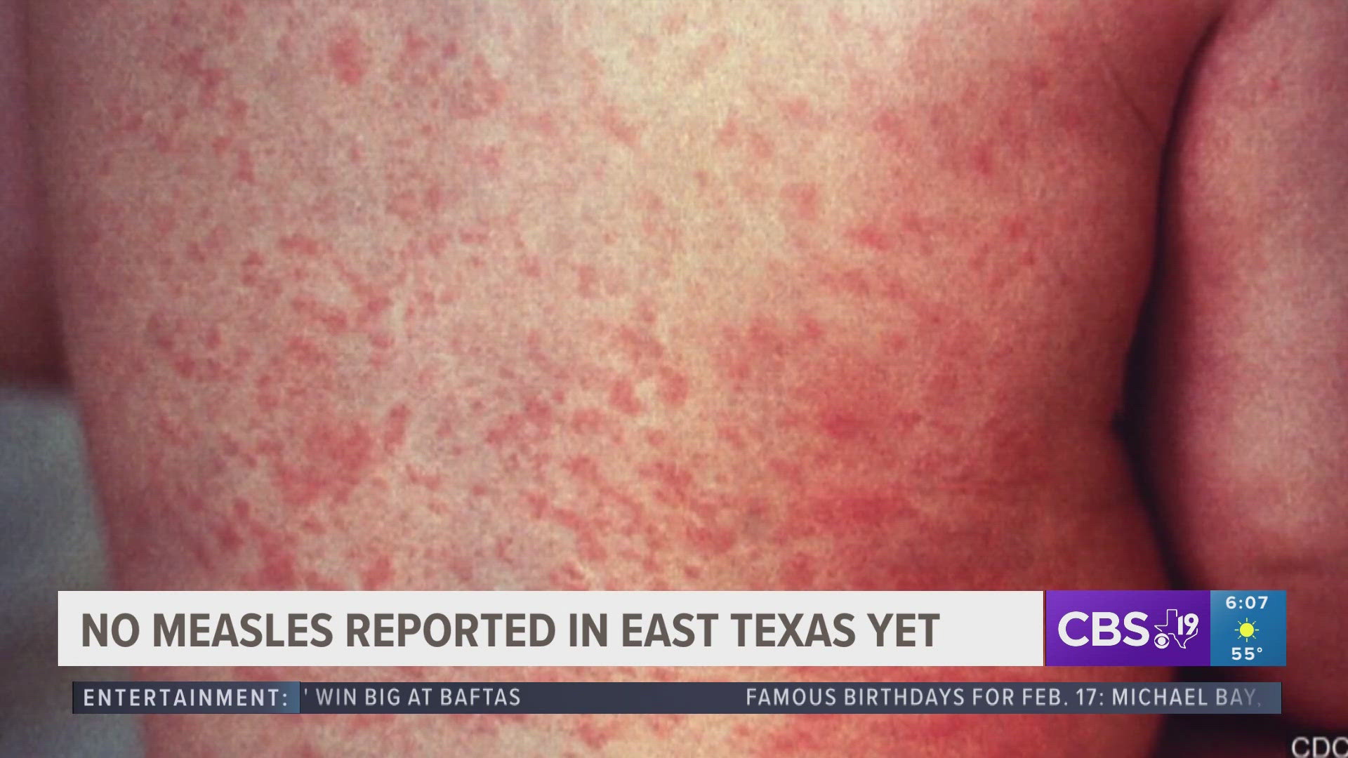 Doctors monitoring rise in measles in West Texas | cbs19.tv